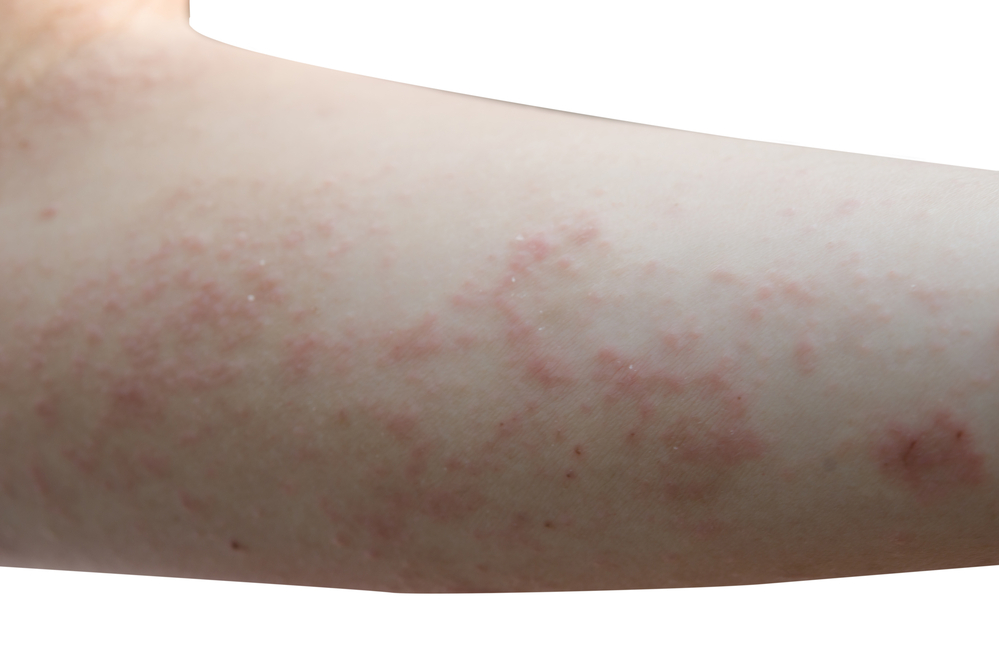 Scabies is an infectious skin condition | SCGW